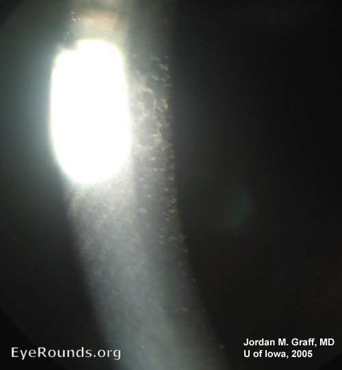 Corneal Dystrophy Fuchs Endothelial Late Onset Hereditary Ocular